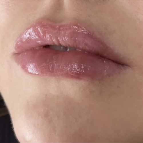 Our Work - Visage Medical Aesthetics Regina | Botox, Lip Filler, PRP Hair