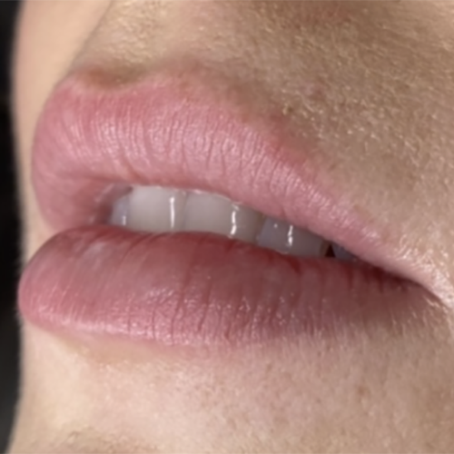 Our Work - Visage Medical Aesthetics Regina | Botox, Lip Filler, PRP Hair