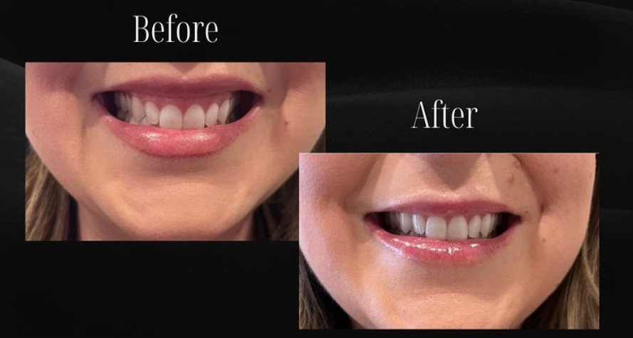 Fix Your Gummy Smile with Botox Treatment in Regina at Visage
