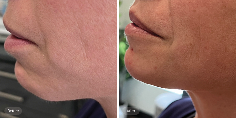 Enhancing Your Chin with Dermal Fillers: Achieve a Defined and Balanced ...