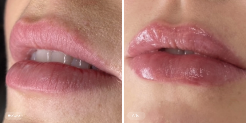 Our Work - Visage Medical Aesthetics Regina | Botox, Lip Filler, PRP Hair